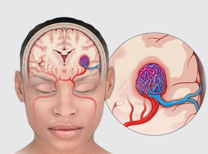 Arteriovenous Malformation causes, symptoms and Treatment